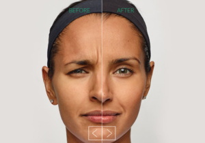 10 Things to Expect with Botox – West Institute | Chevy Chase ...