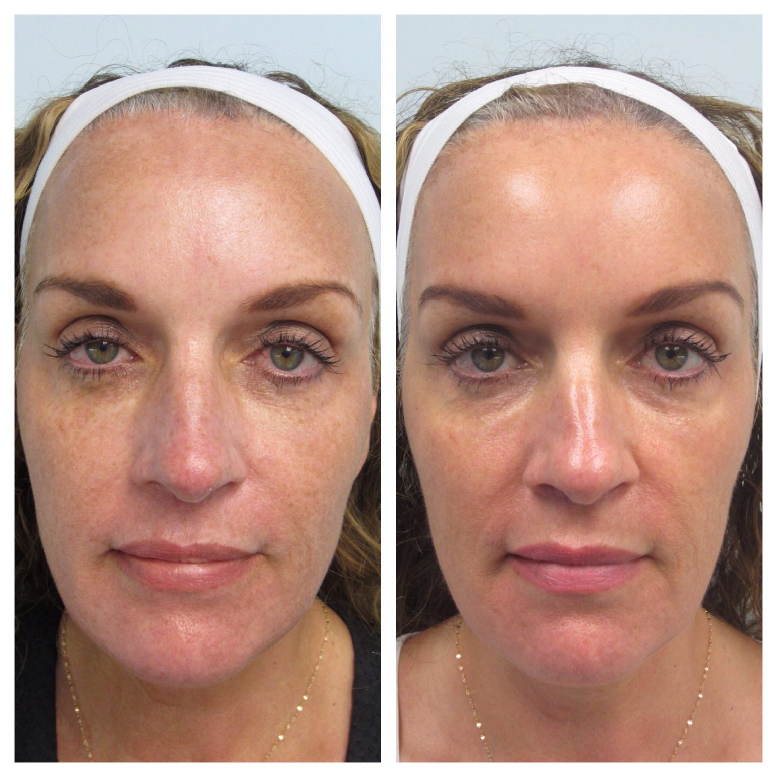 Erasing Your Sun Damage: The New Fraxel Dual Treatment – West Institute ...