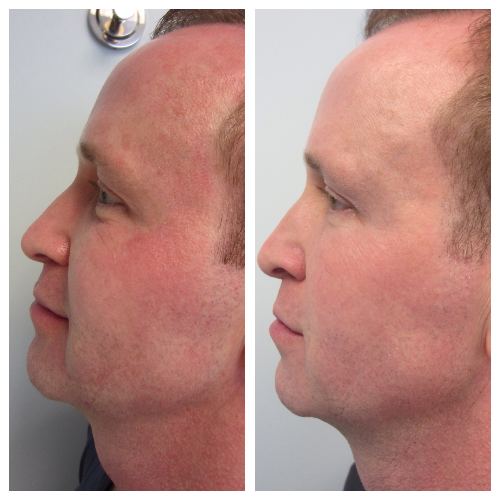 The Dynamic Way to Replace Volume in Male Patients [Video] – West ...